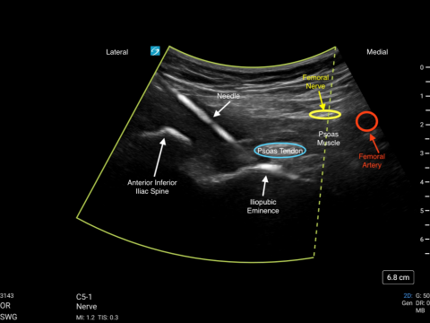 How to Perform an Ultrasound-Guided PENG Block | FUJIFILM Sonosite